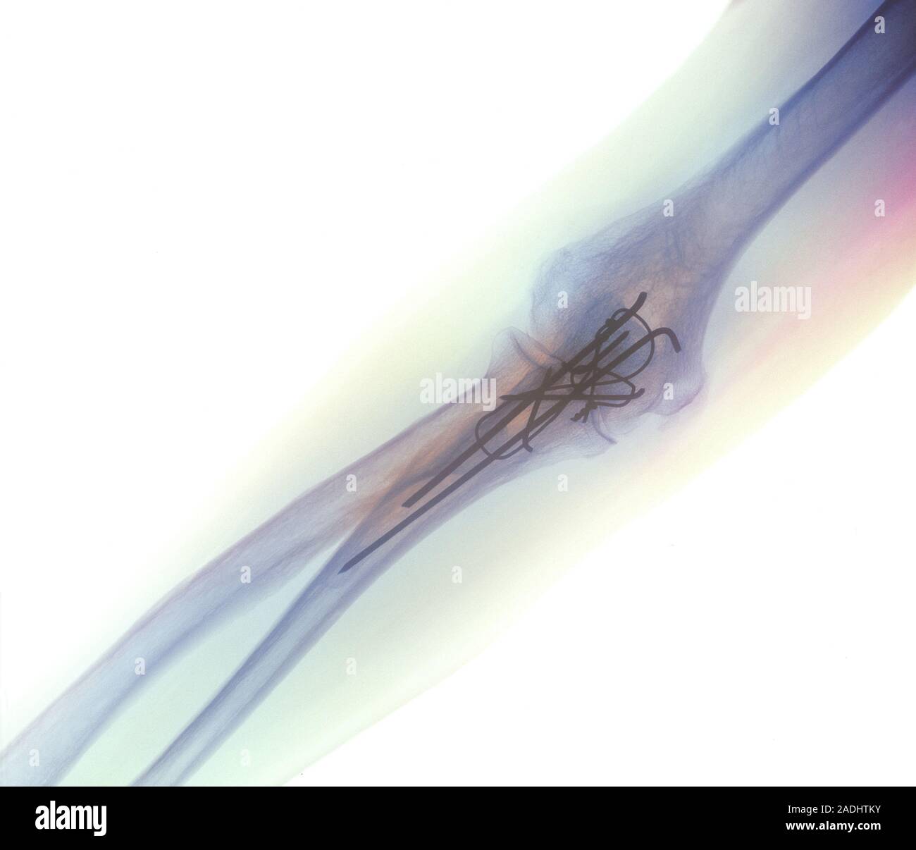 Pinned elbow fracture. Coloured X-ray showing metal pins (black) in a ...