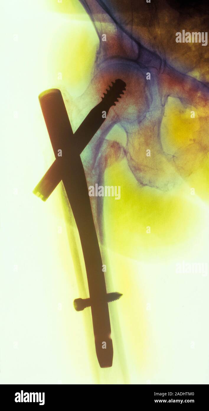 Pinned femur fracture. Coloured X-ray of a pinned fracture of the femur ...