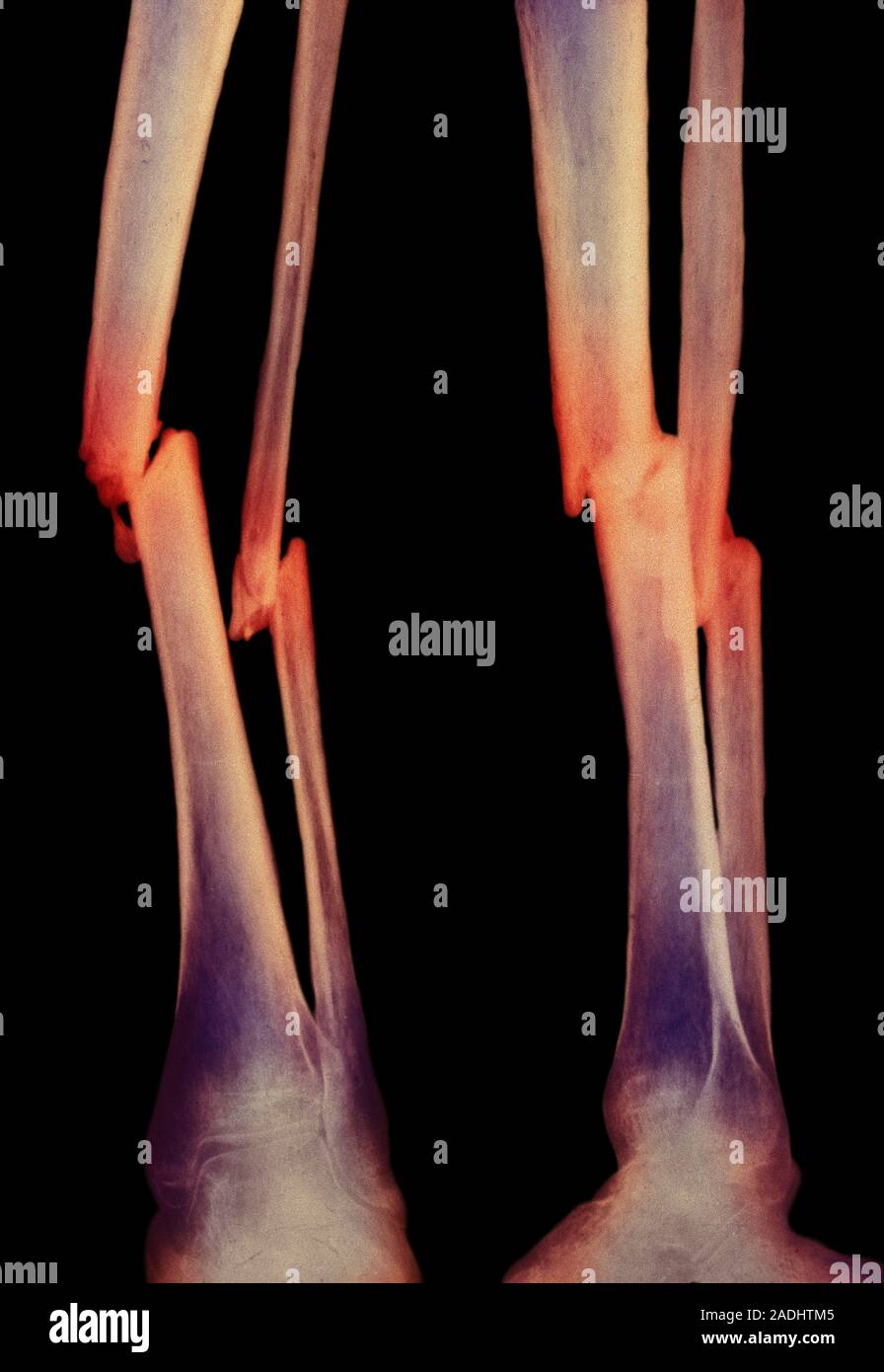 Broken leg bones. Coloured X-rays of fractures in the bones of the ...