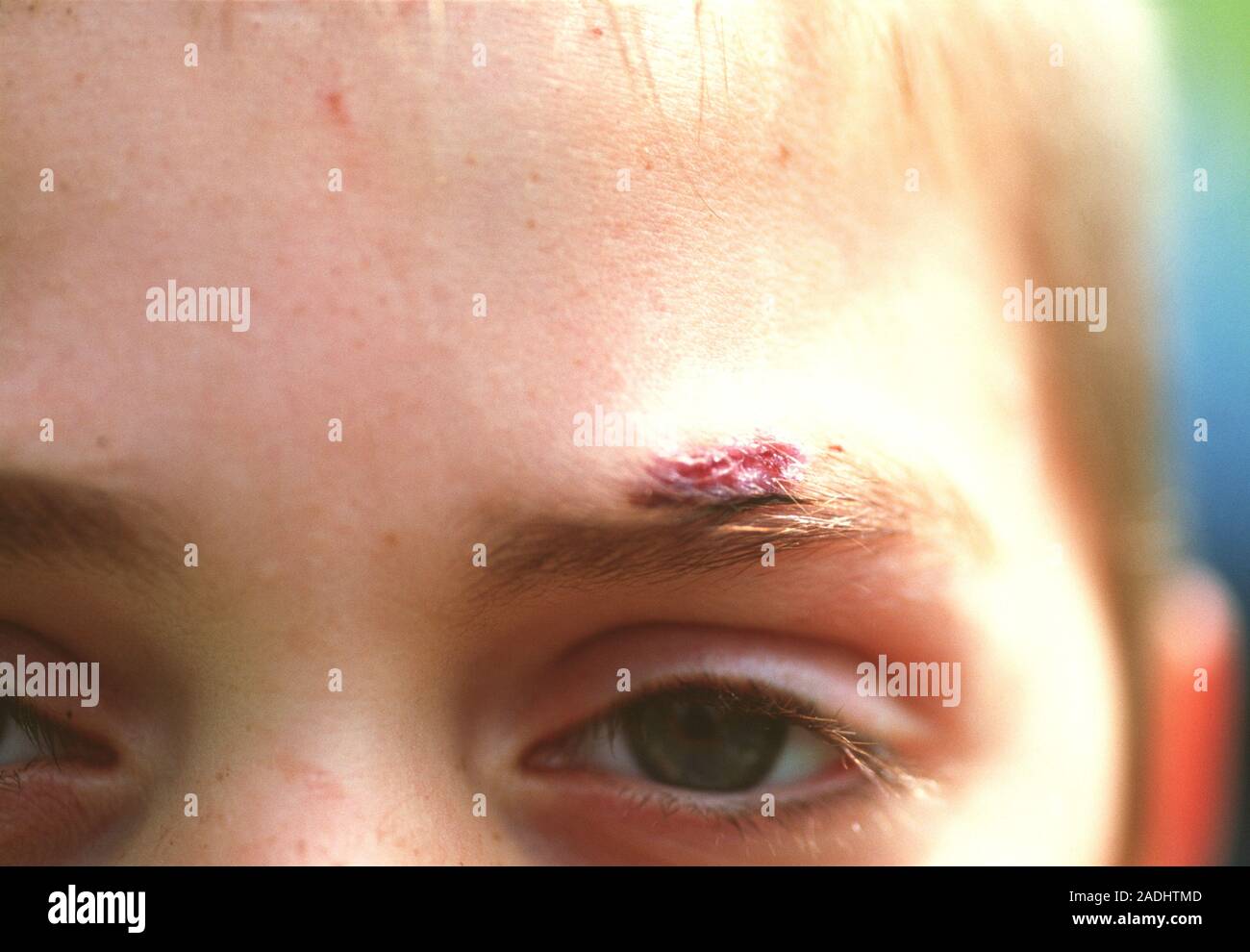 Glued cut. Treated cut on a boy's eyebrow. This cut has been treated ...