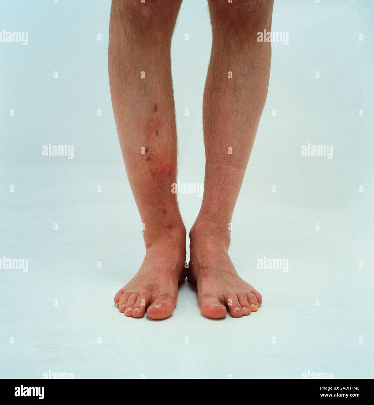 Broken lower leg (at left) of a man. His leg was fractured by a runaway ...