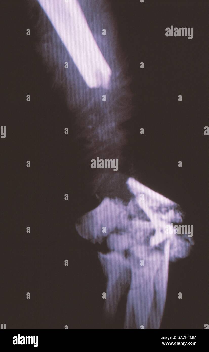 Broken arm X-ray. Image 1 of 2. X-ray of a severely damaged arm. The ...