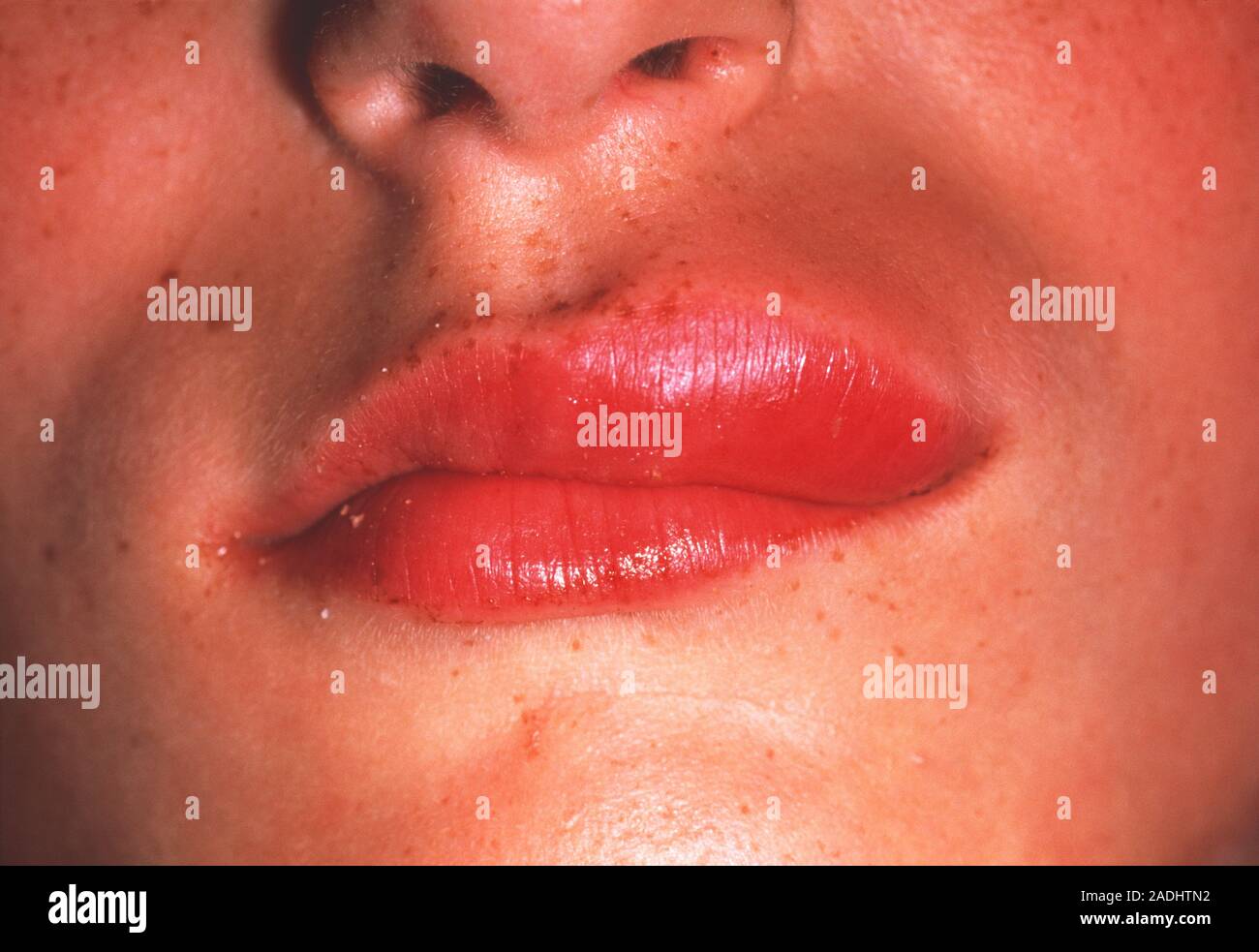 Swollen lip of a 12-year-old boy. The lip was injured during a fall ...