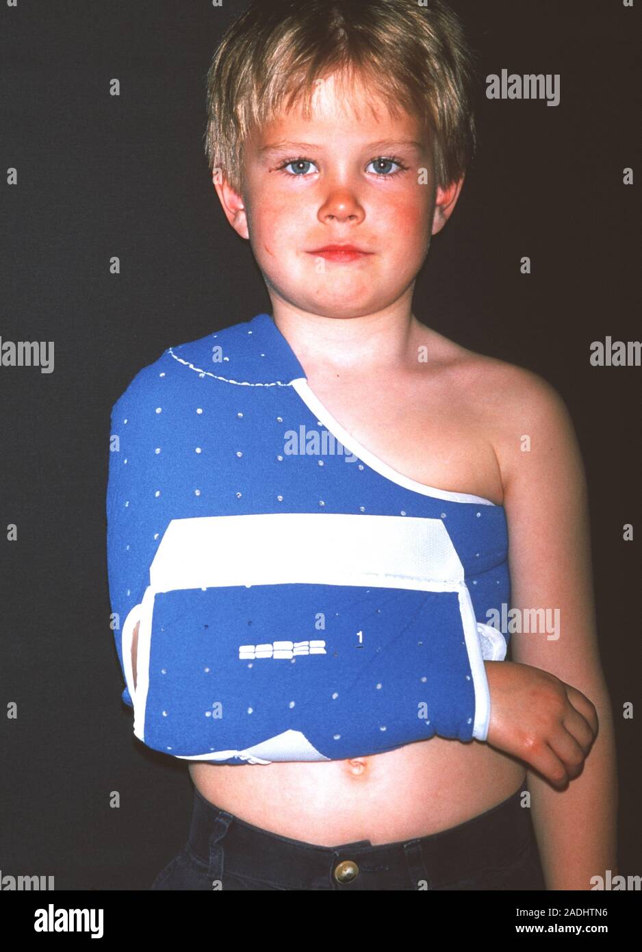 Broken arm. 6-year-old boy with his broken upper arm (humerus ...