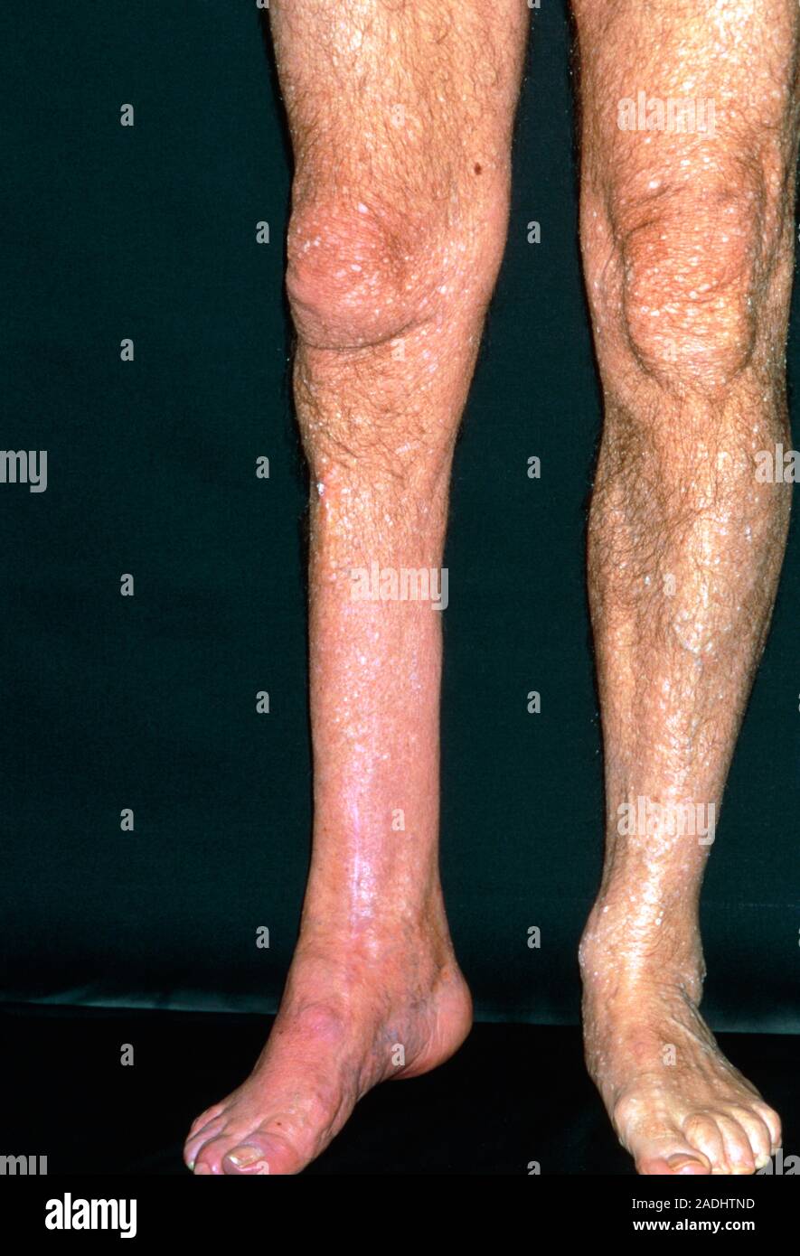 Muscle Wasting Right Leg Of A 73 Year Old Man With Atrophy Wasting Of The Calf Muscles These