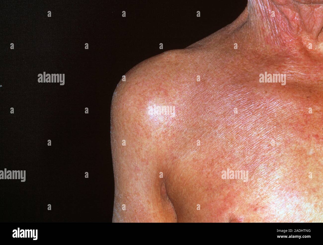 Effusion of the shoulder of a 76 year old man. Effusion is the ...