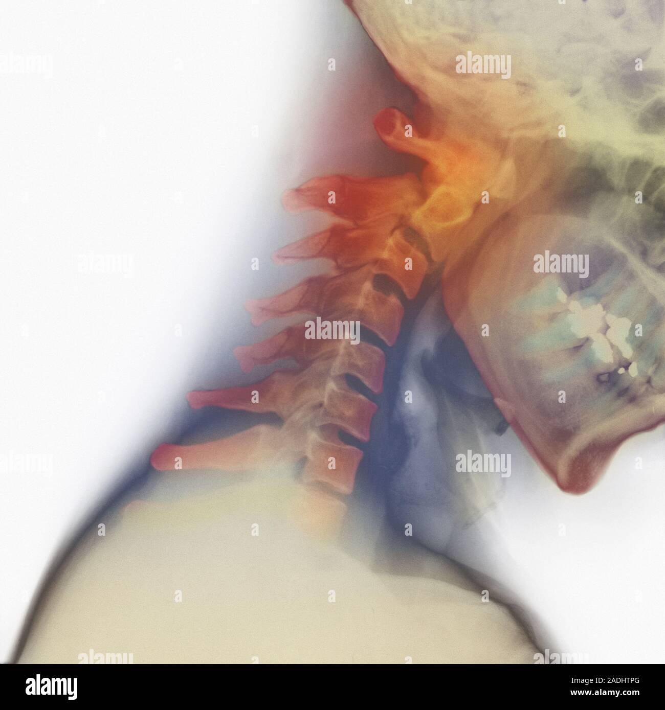 Broken neck. Coloured X-ray of a fracture of the second cervical (neck ...