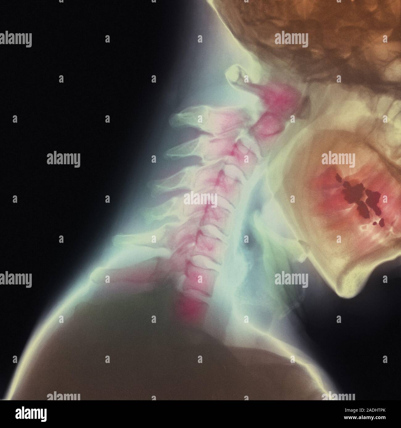 Broken neck. Coloured X-ray of a fracture of the second cervical (neck ...