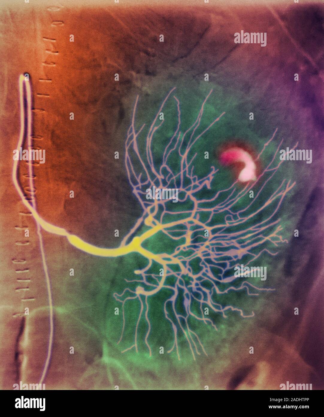 Internal bleeding. Coloured X-ray angiogram of internal abdominal ...