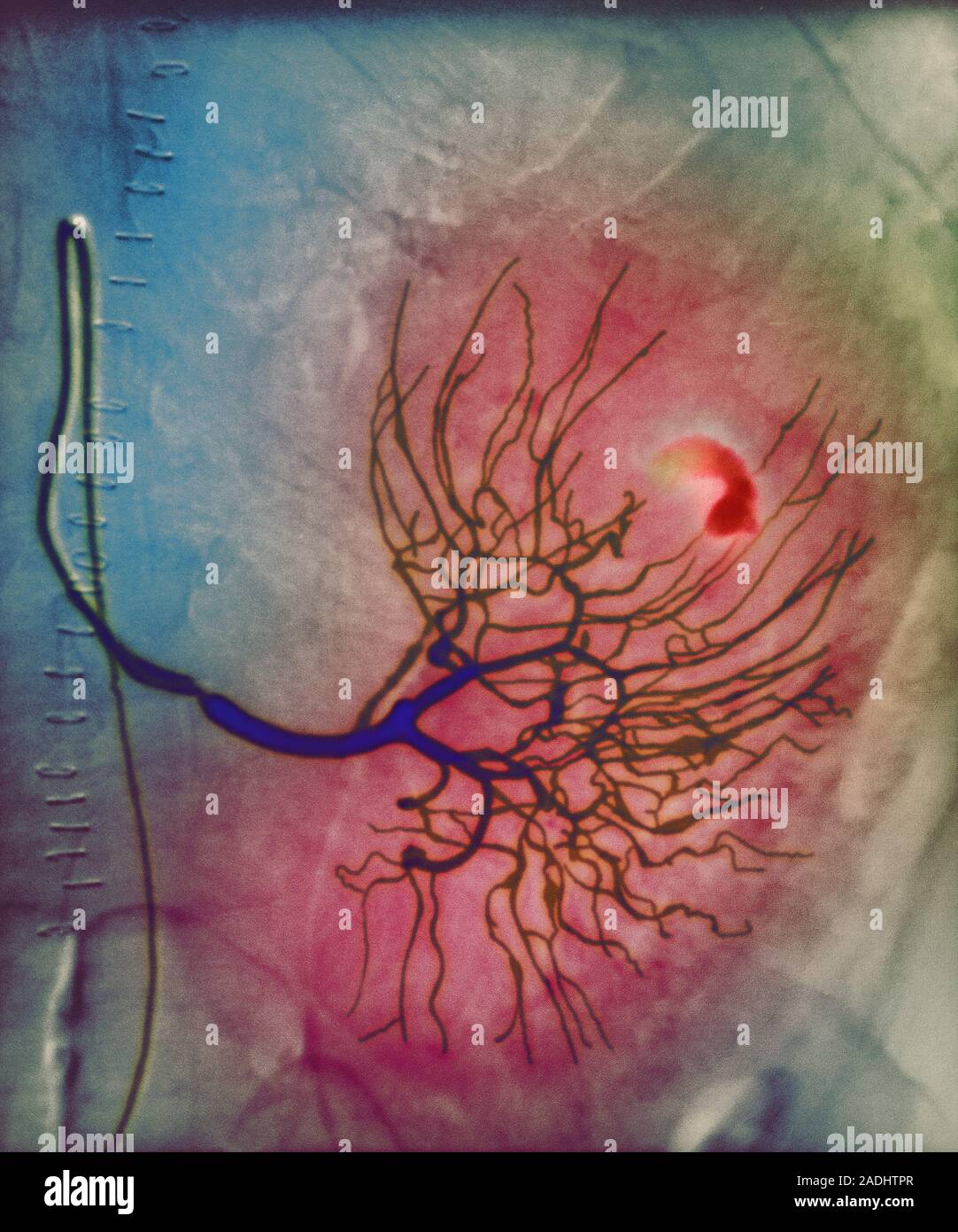 Internal bleeding. Coloured X-ray angiogram of internal abdominal ...