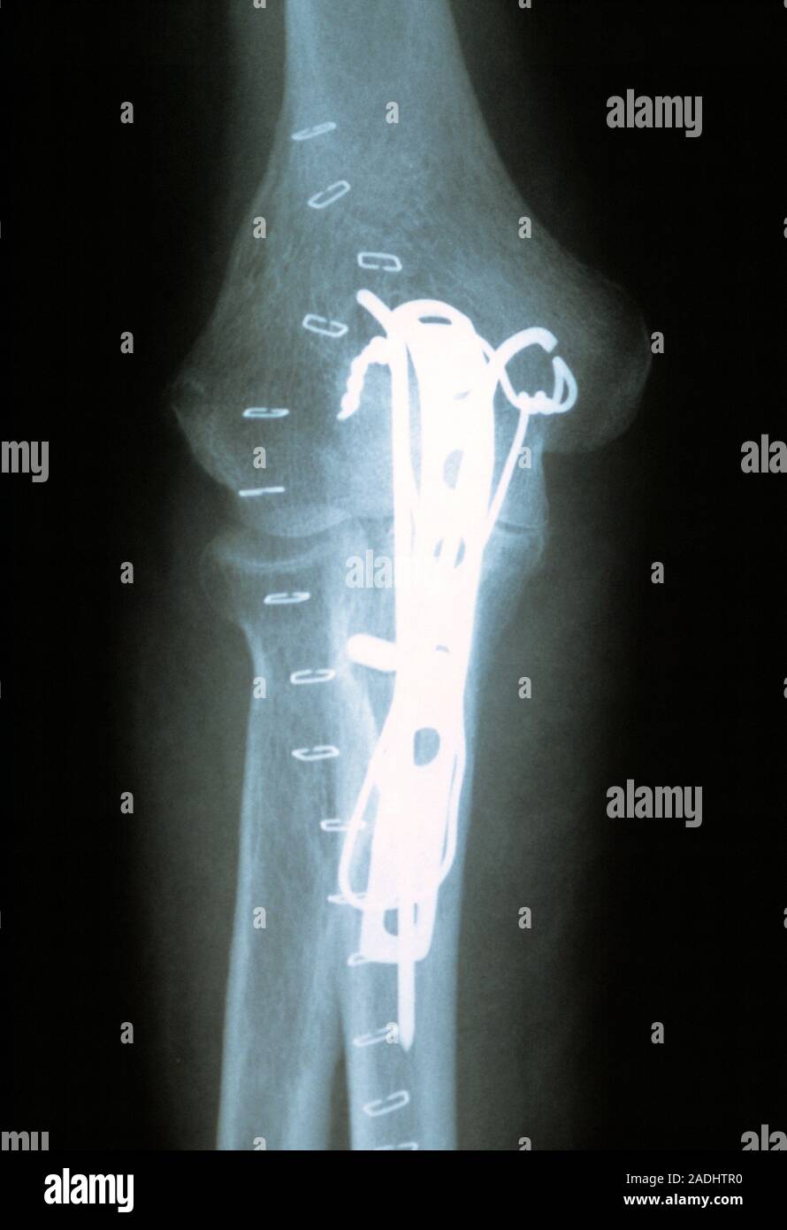 Pinned elbow fracture. X-ray of the arm of an 84- year-old woman ...
