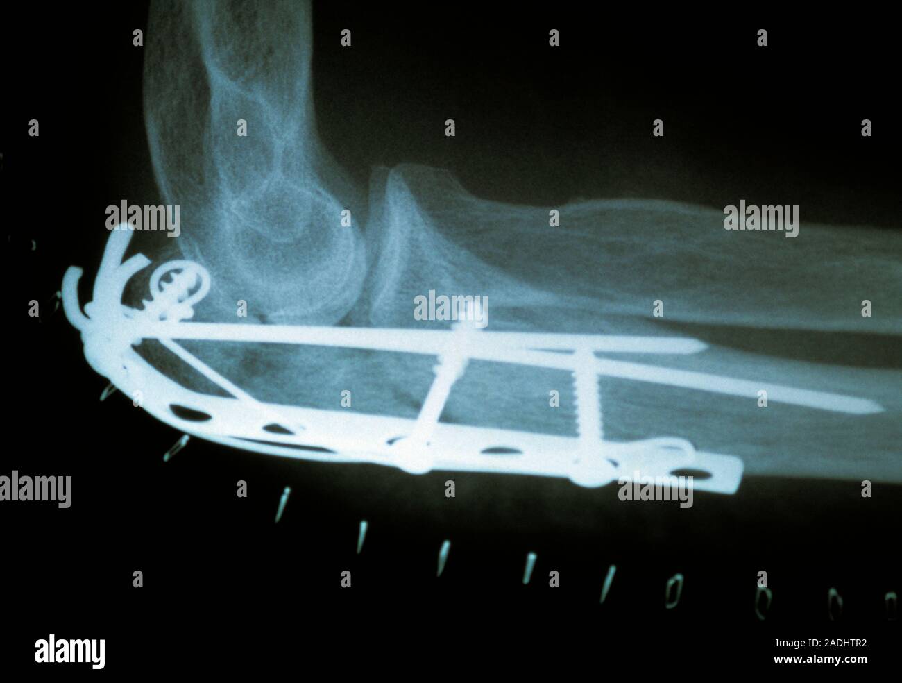 Pinned elbow fracture. X-ray of the arm of an 84- year-old woman ...