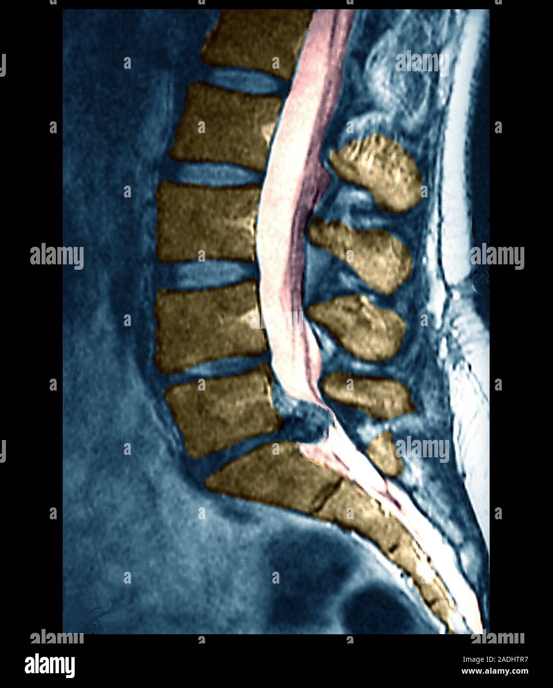 Slipped disc. Coloured magnetic resonance imaging (MRI) scan of a ...