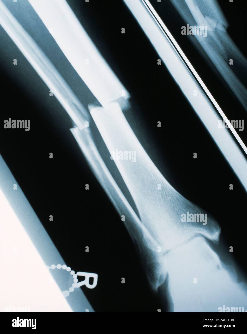 Lower leg fracture. X-ray of a fracture through the fibula (thinner ...