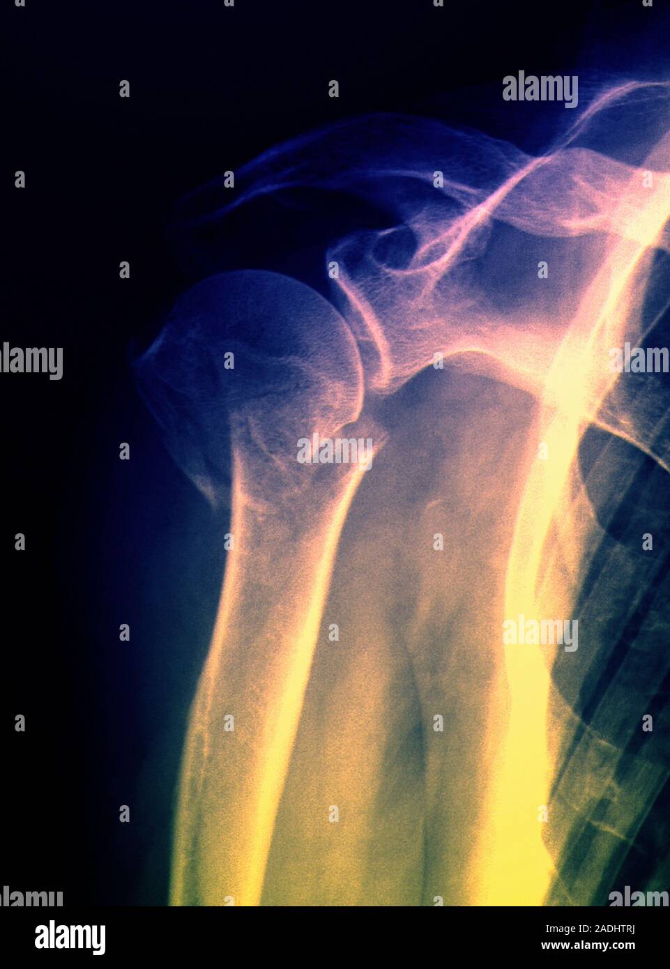 Broken upper arm bone. Coloured X-ray of the right shoulder of a ...