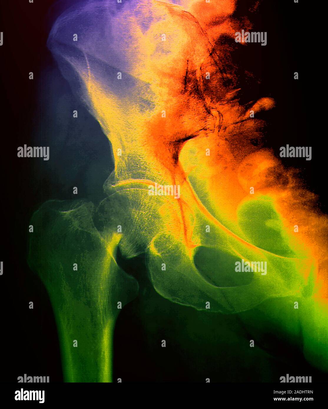 Broken hip. Coloured X-ray of the right hip of a patient, showing a ...