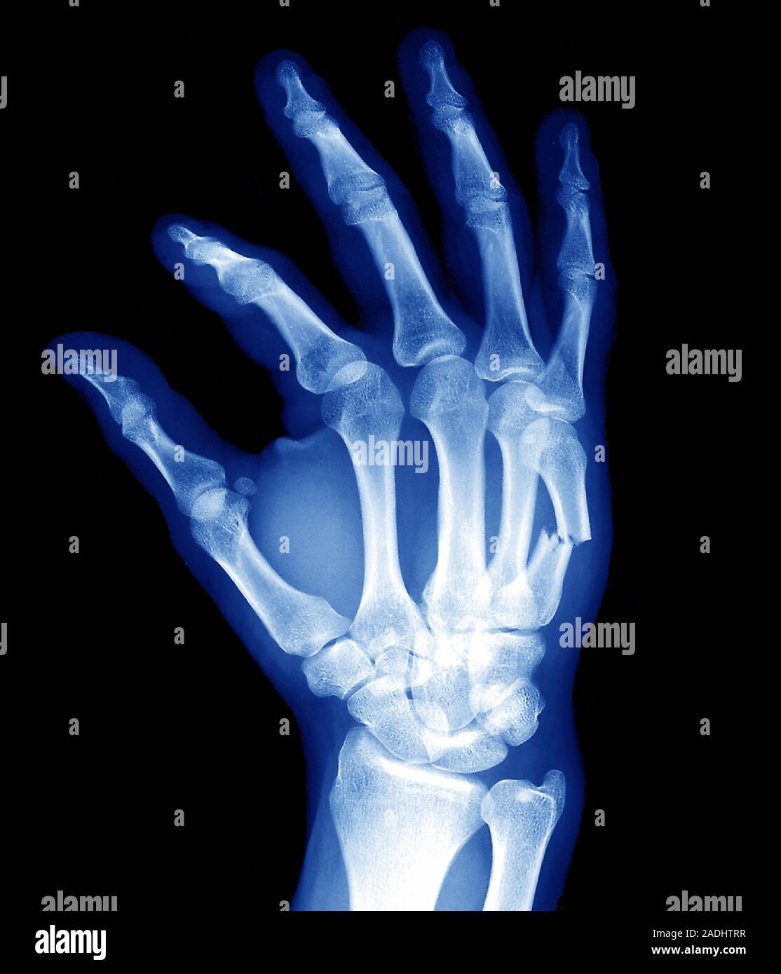 Broken hand bone. Coloured X-ray of the right hand of a patient ...