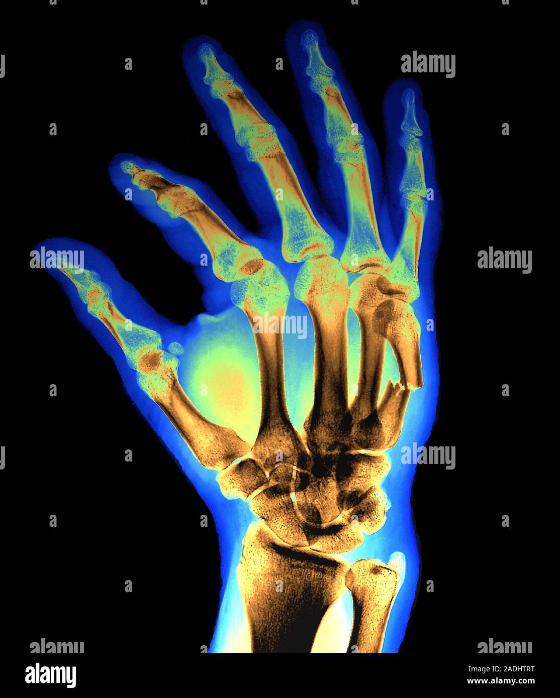 Broken hand bone. Coloured X-ray of the right hand of a patient ...