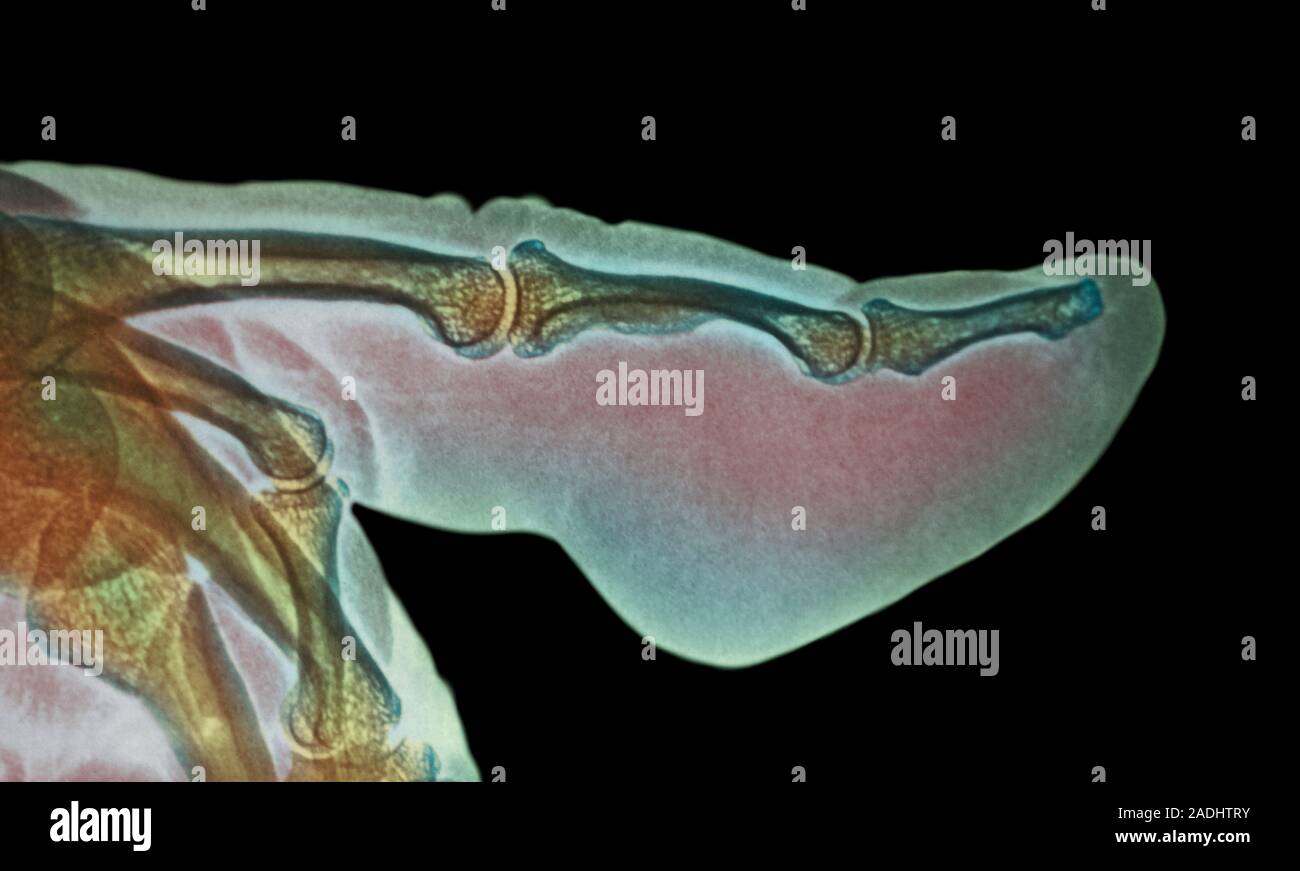 Inflamed finger. Coloured X-ray of a pointing finger, with an ...