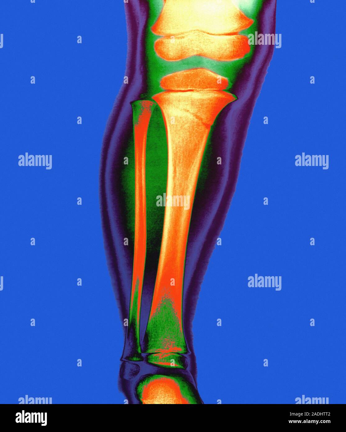 Leg fracture. Coloured X-ray of a fractured leg. The fracture line is ...
