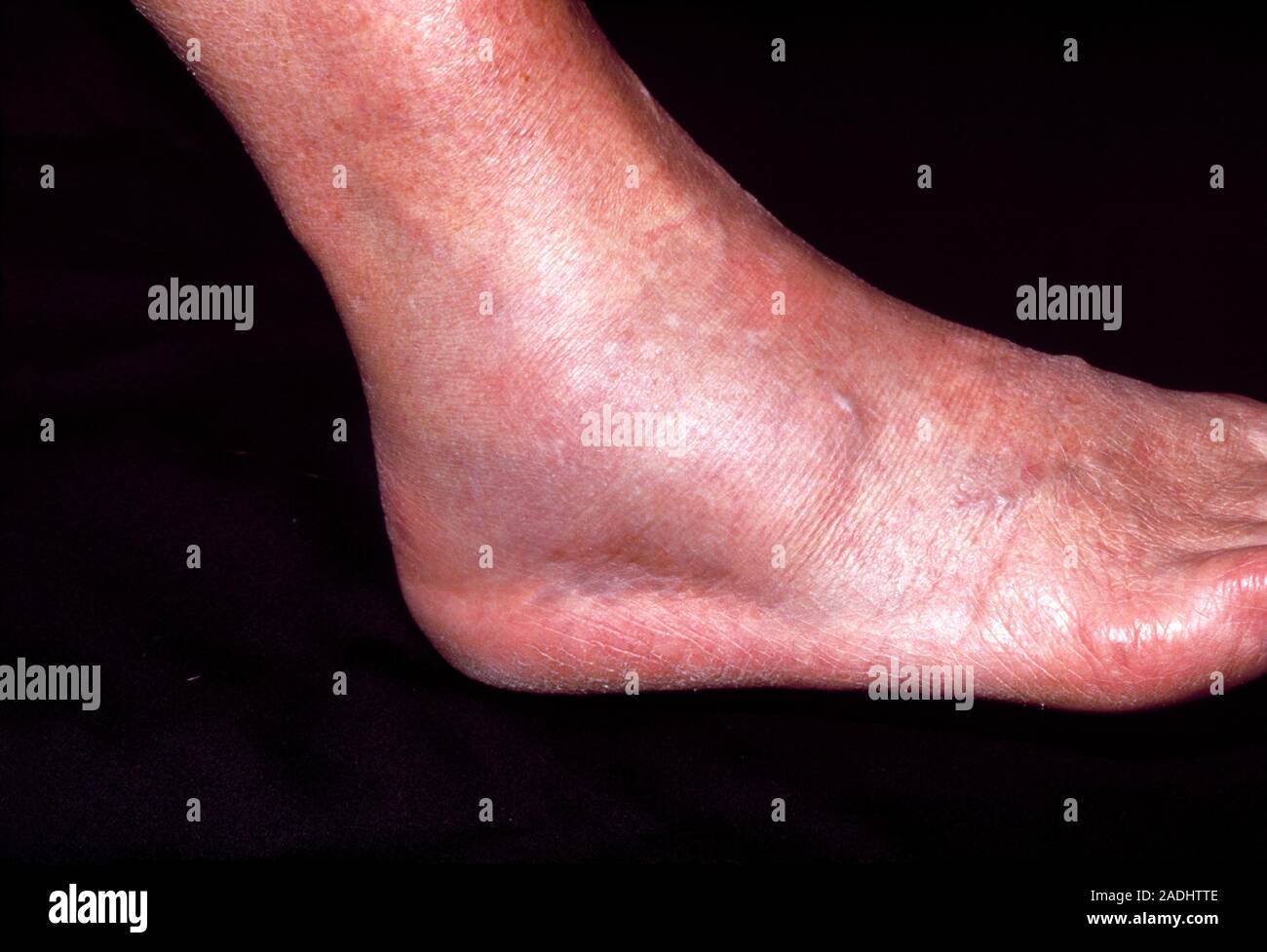 Broken ankle. Close-up of swelling around the broken ankle of a 36 year ...