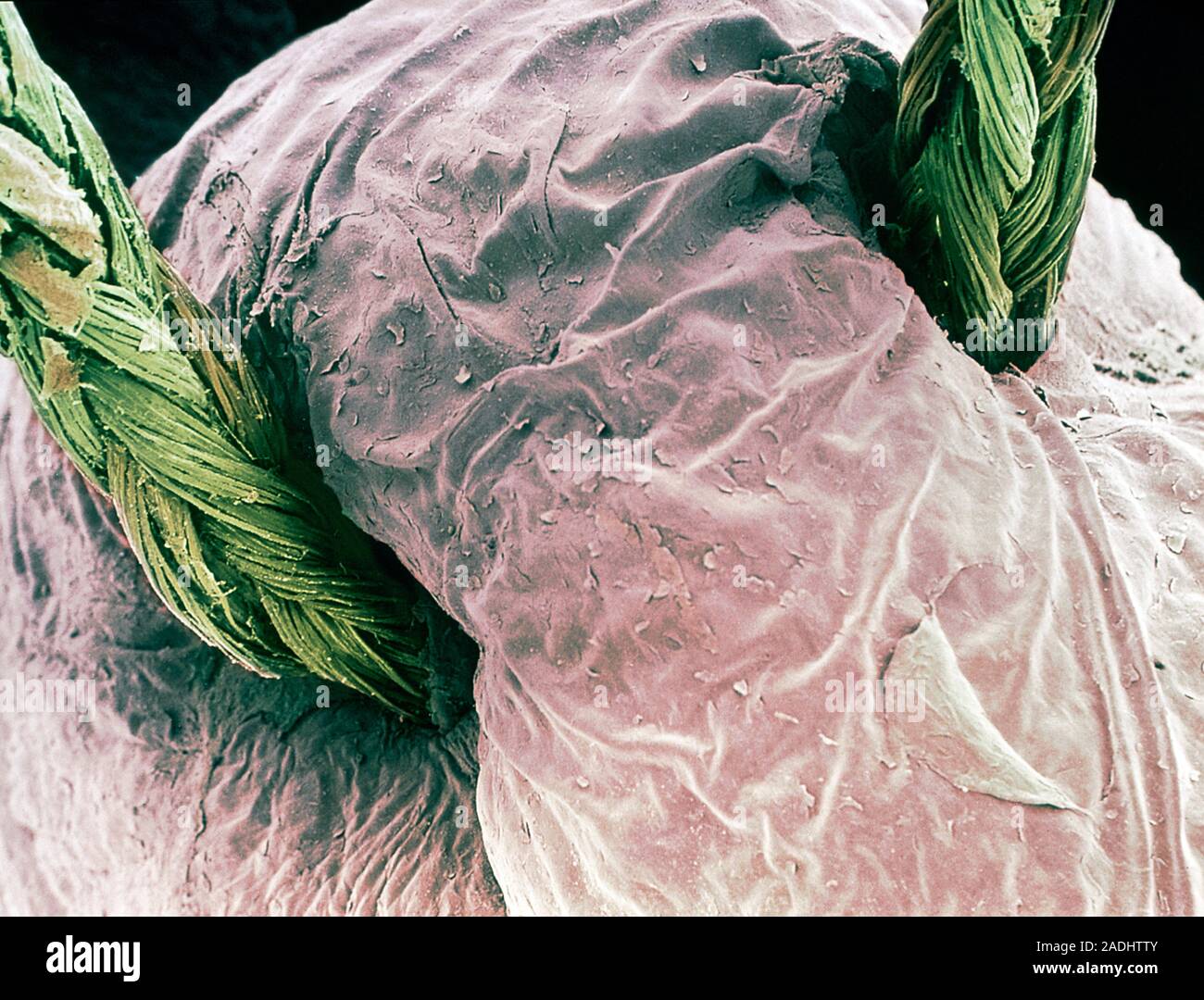 Suture. Coloured scanning electron micrograph (SEM) of a suture (green ...