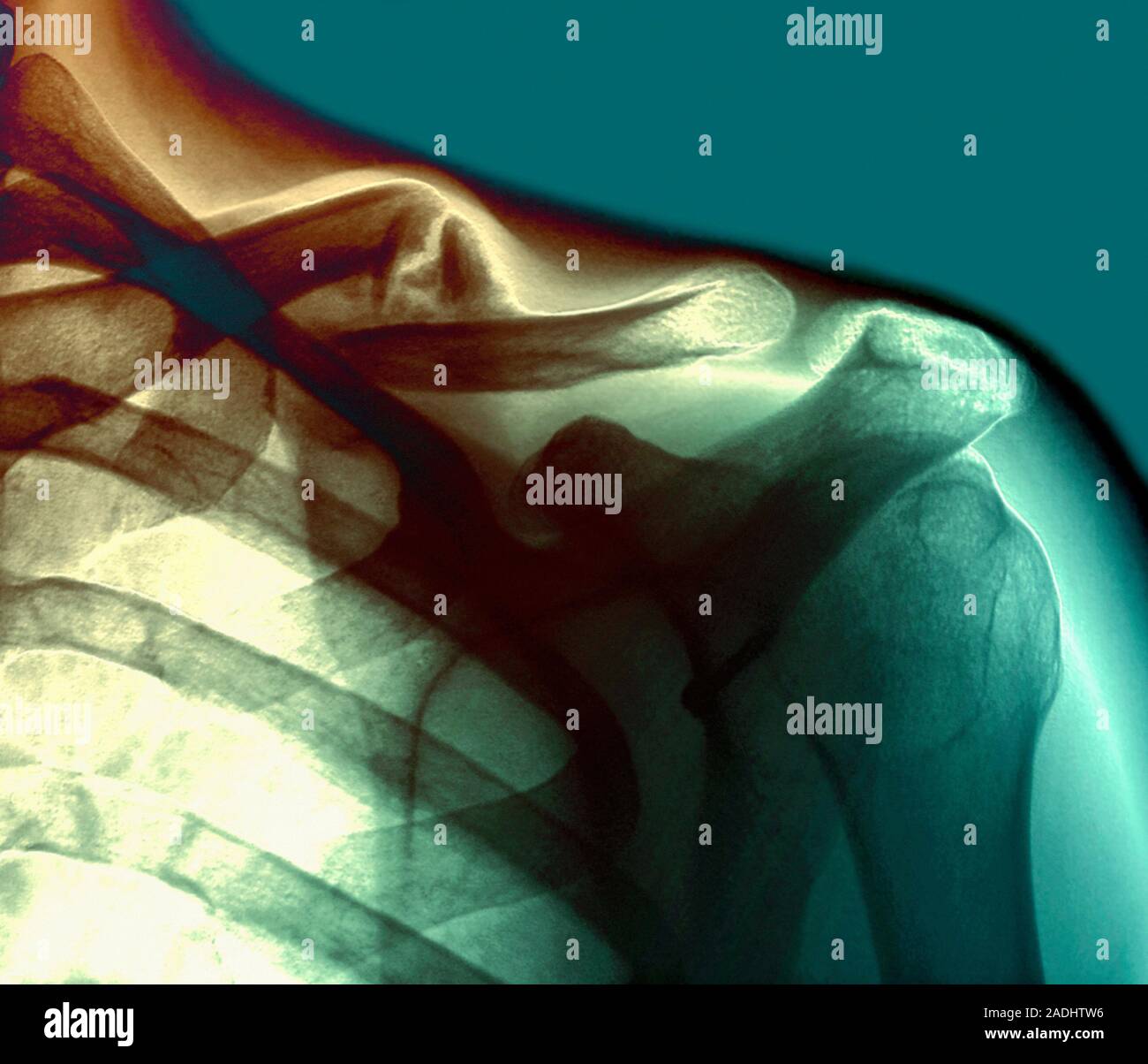 Broken Collar Bone Coloured X Ray Of A Callus Lump Upper Left On An