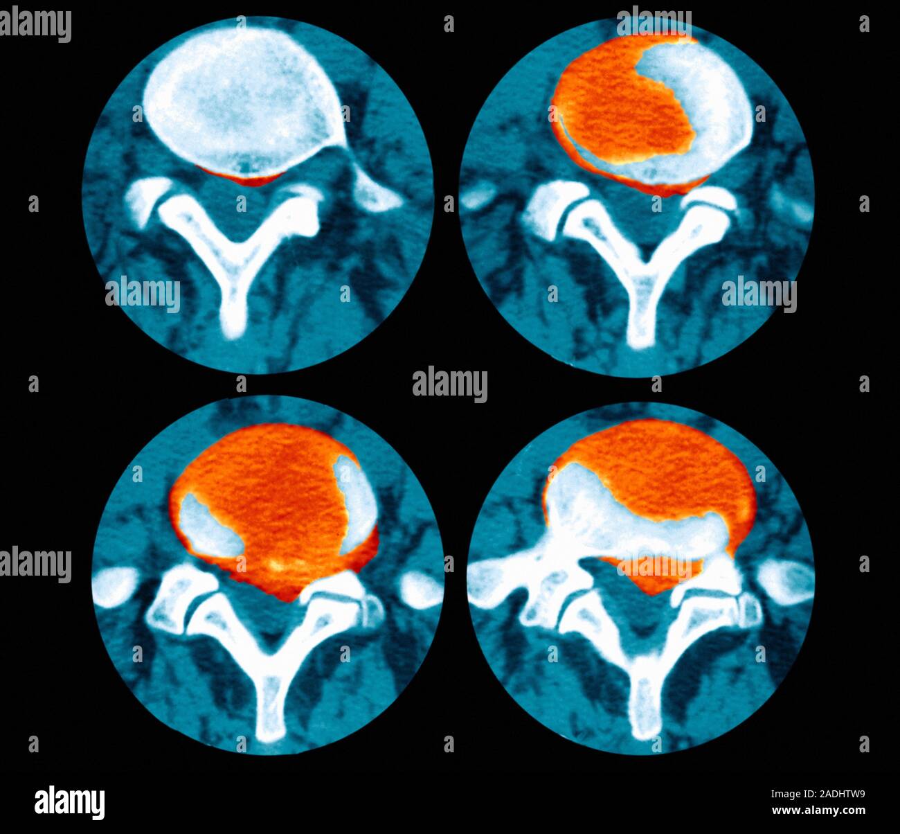 Slipped disc. Coloured computed tomography (CT) scans of four axial ...