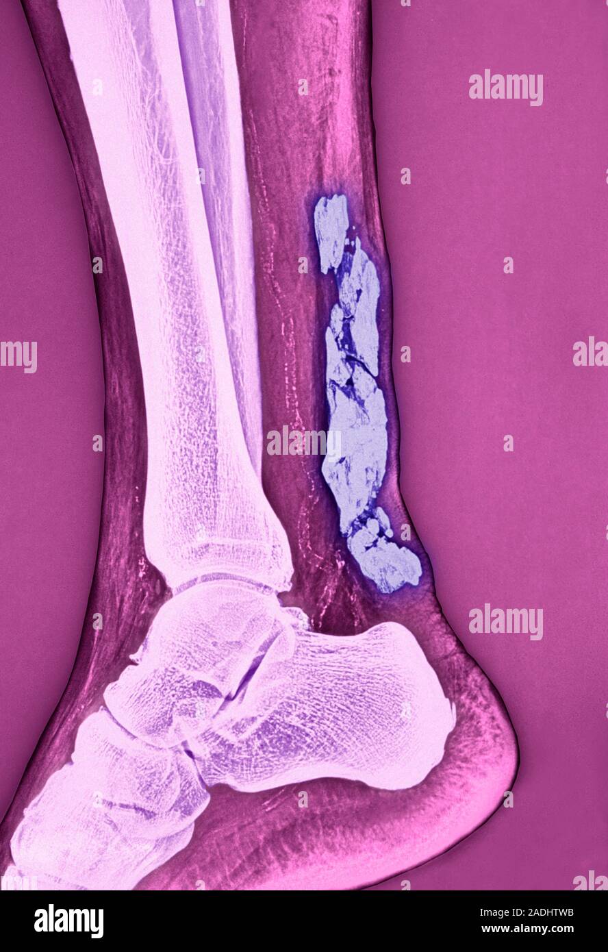 Achilles tendinitis. Coloured X-ray of calcification (centre right) of ...
