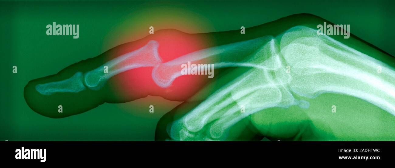 Dislocated finger. Coloured X-ray showing the dislocation (pink ...