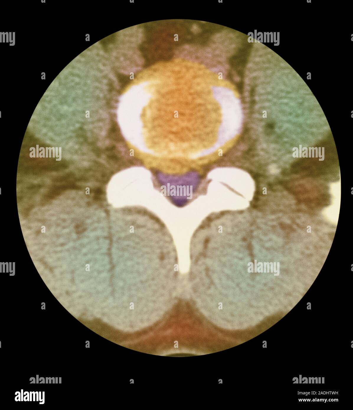 Slipped disc. Coloured computed tomography (CT) scan of an axial ...