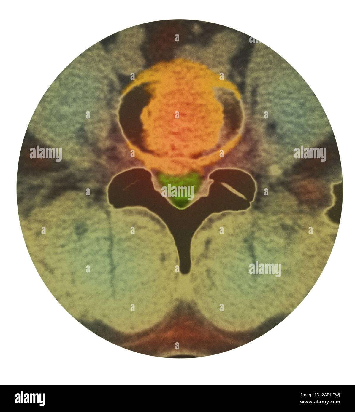 Slipped disc. Coloured computed tomography (CT) scan of an axial ...