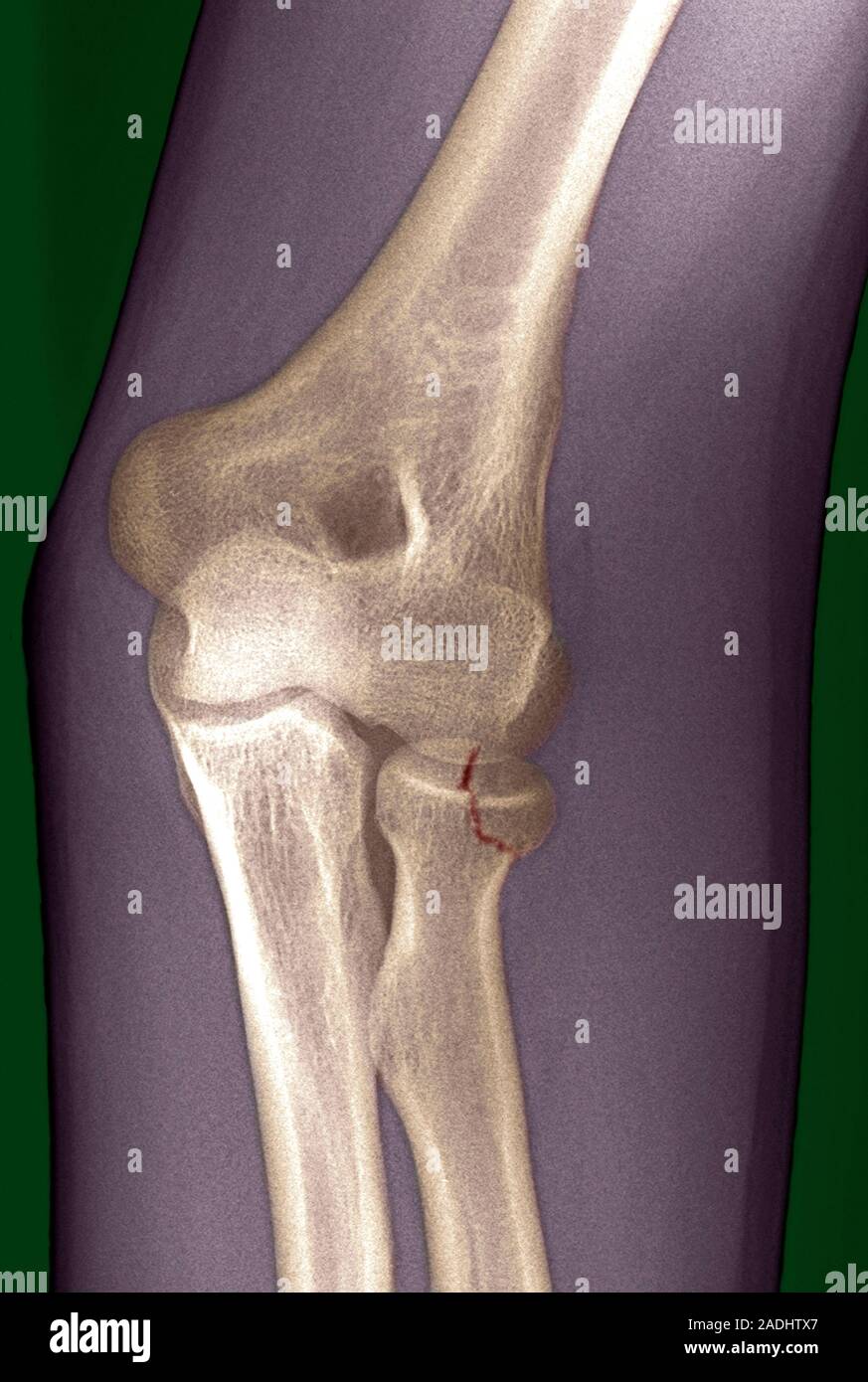 Broken arm, X-ray. Coloured X-ray of a fracture (red) at the head of ...