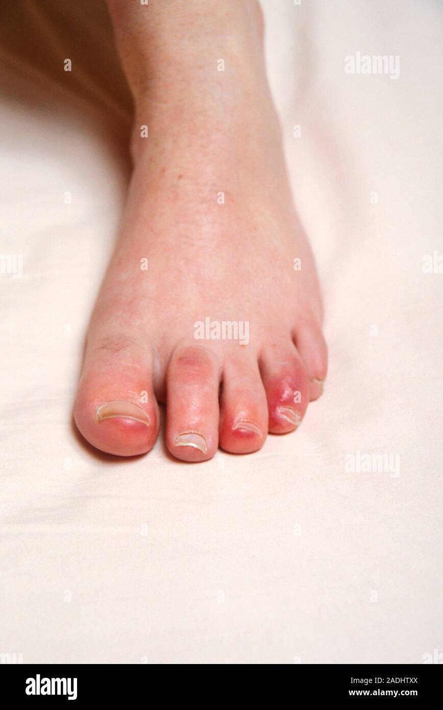 Frostbitten toes. Frostbite causes damage to body tissues by the ...