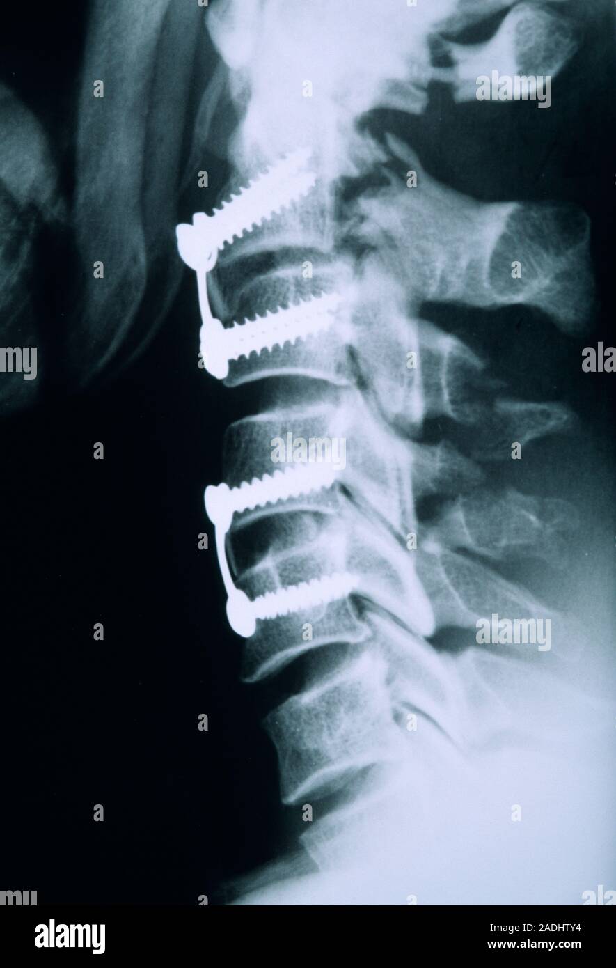 Broken neck. Image 2 of 2. X-ray of screws inserted to help mend ...