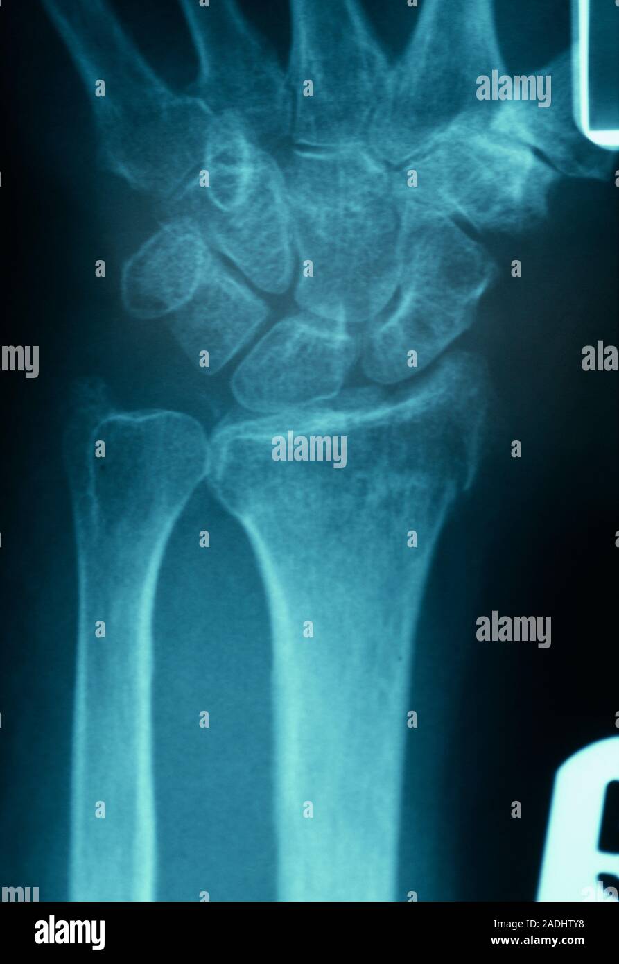 Broken arm. X-ray of the wrist of a 76-year-old female patient, showing ...