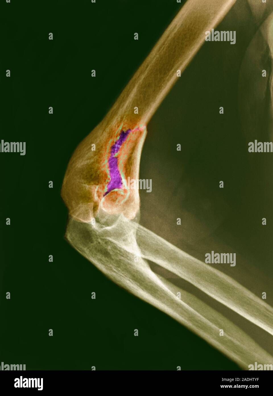 Elbow fracture, coloured X-ray. The bone fracture (purple) is in the ...
