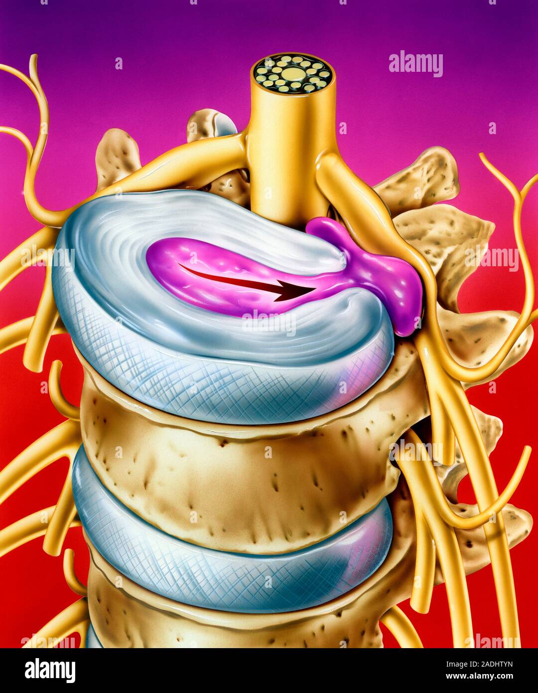 Slipped disc. Artwork of an intervertebral disc (blue) that has ...