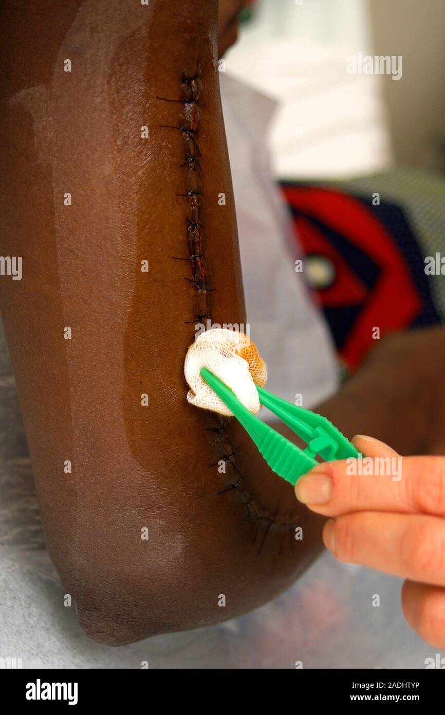 Wound cleaning. Nurse cleaning a surgical wound on a patient's arm by ...