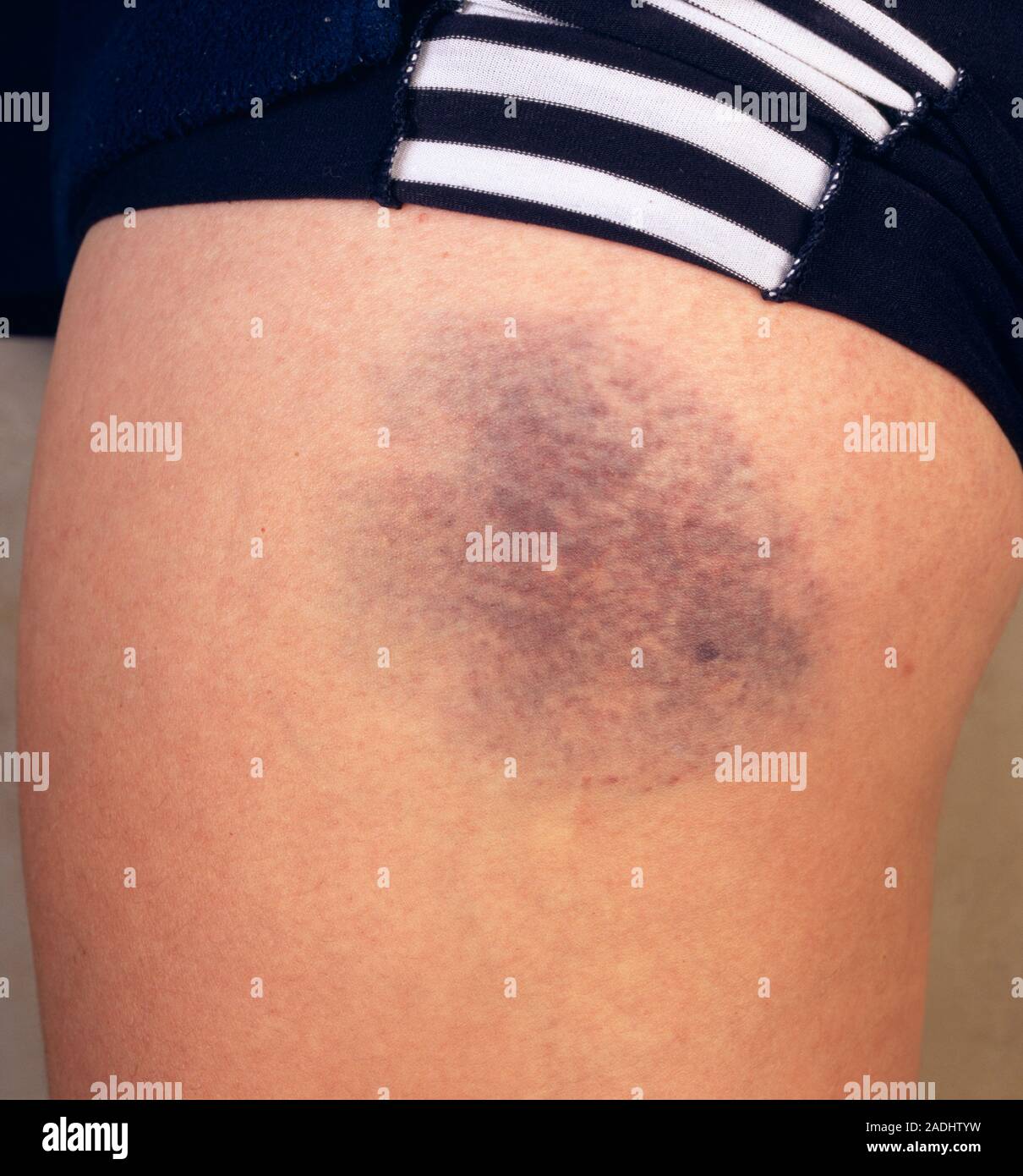 Bruised thigh of a woman injured when she was crushed in a crowd ...