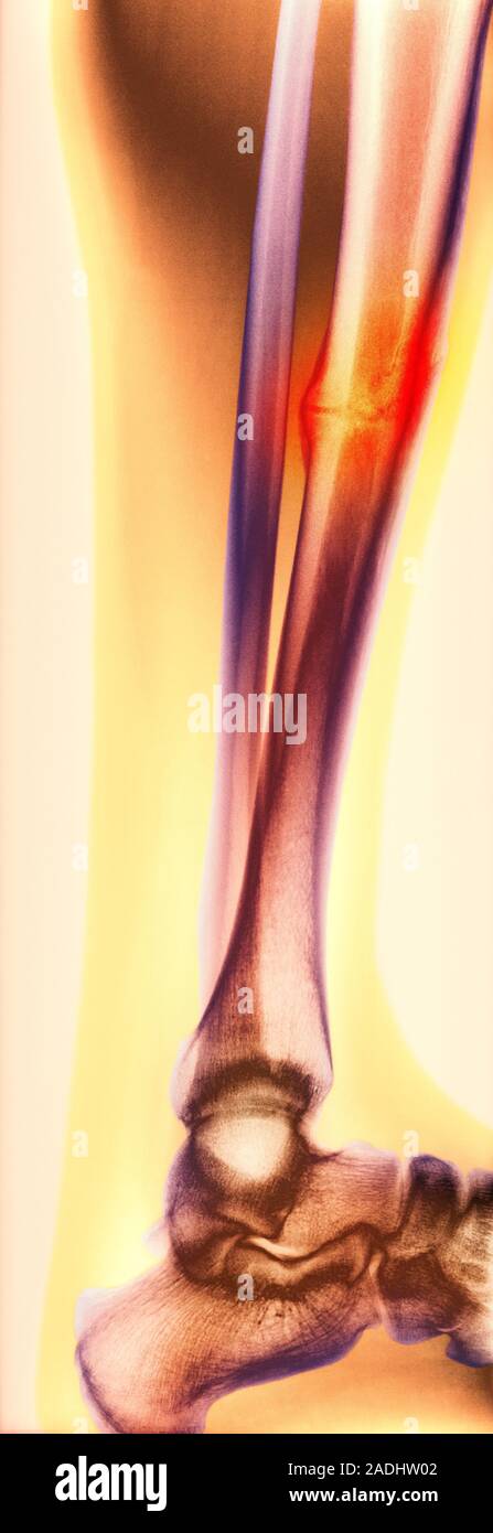 Healed leg fracture. Coloured X-ray of a healed fracture of the tibia ...
