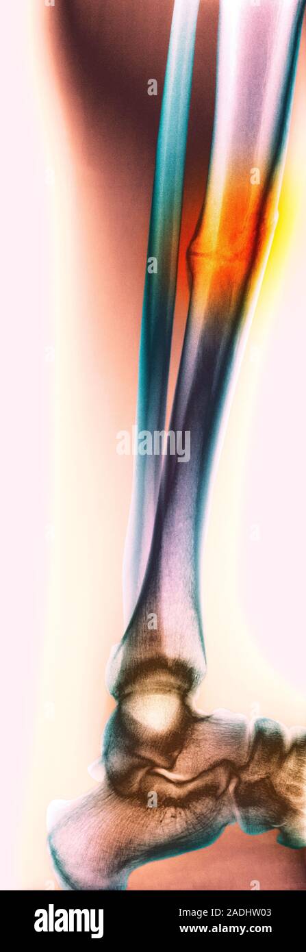 Healed leg fracture. Coloured X-ray of a healed fracture of the tibia ...
