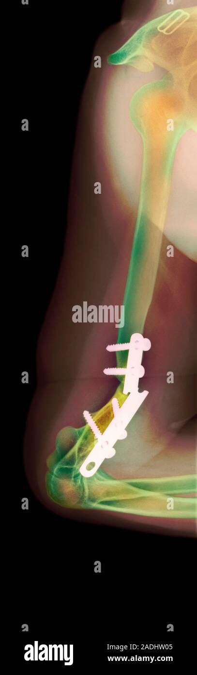Snapped plate on broken arm. Coloured X-ray of a snapped metal plate ...