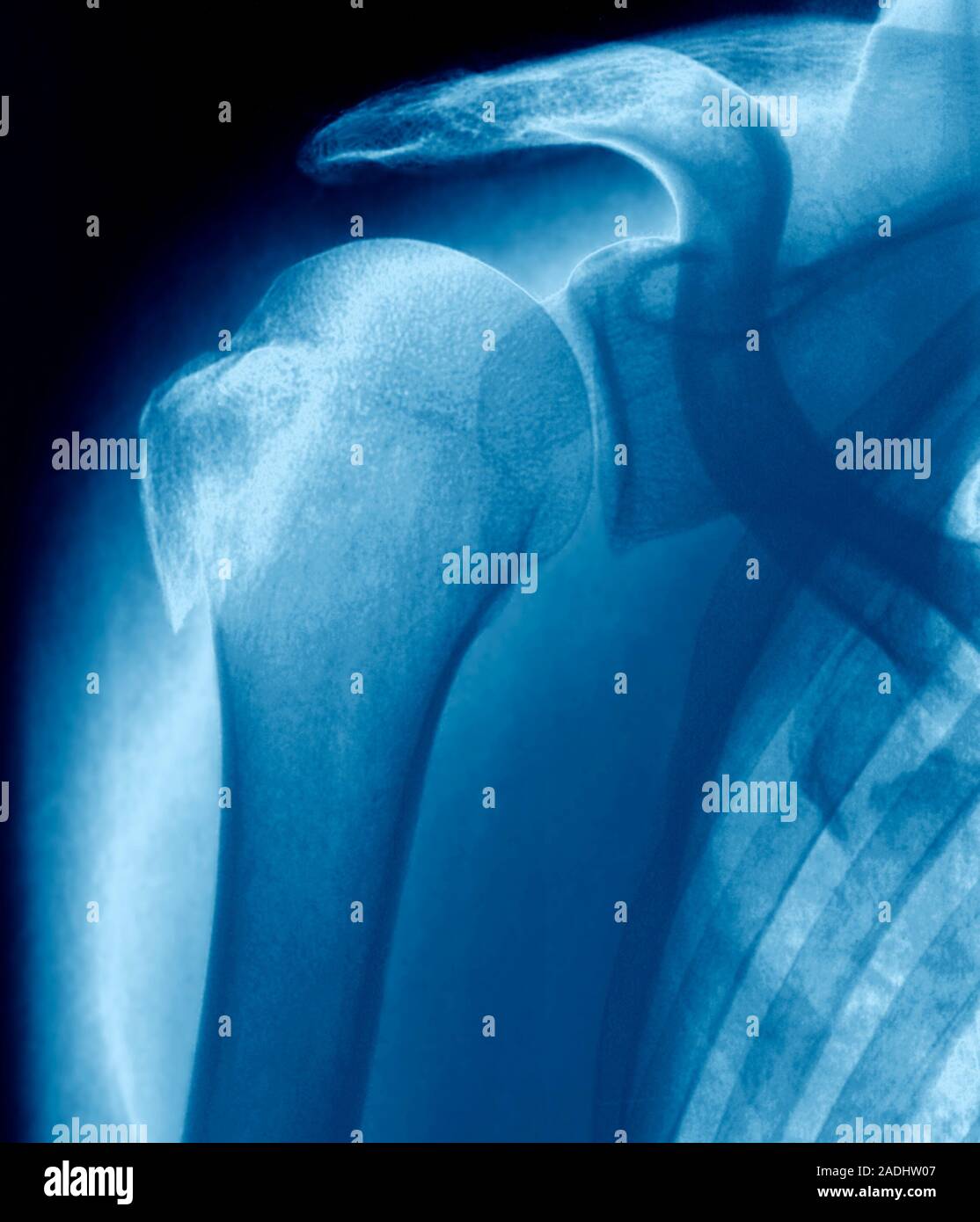Broken upper arm bone. Coloured X-ray of the right shoulder of a ...