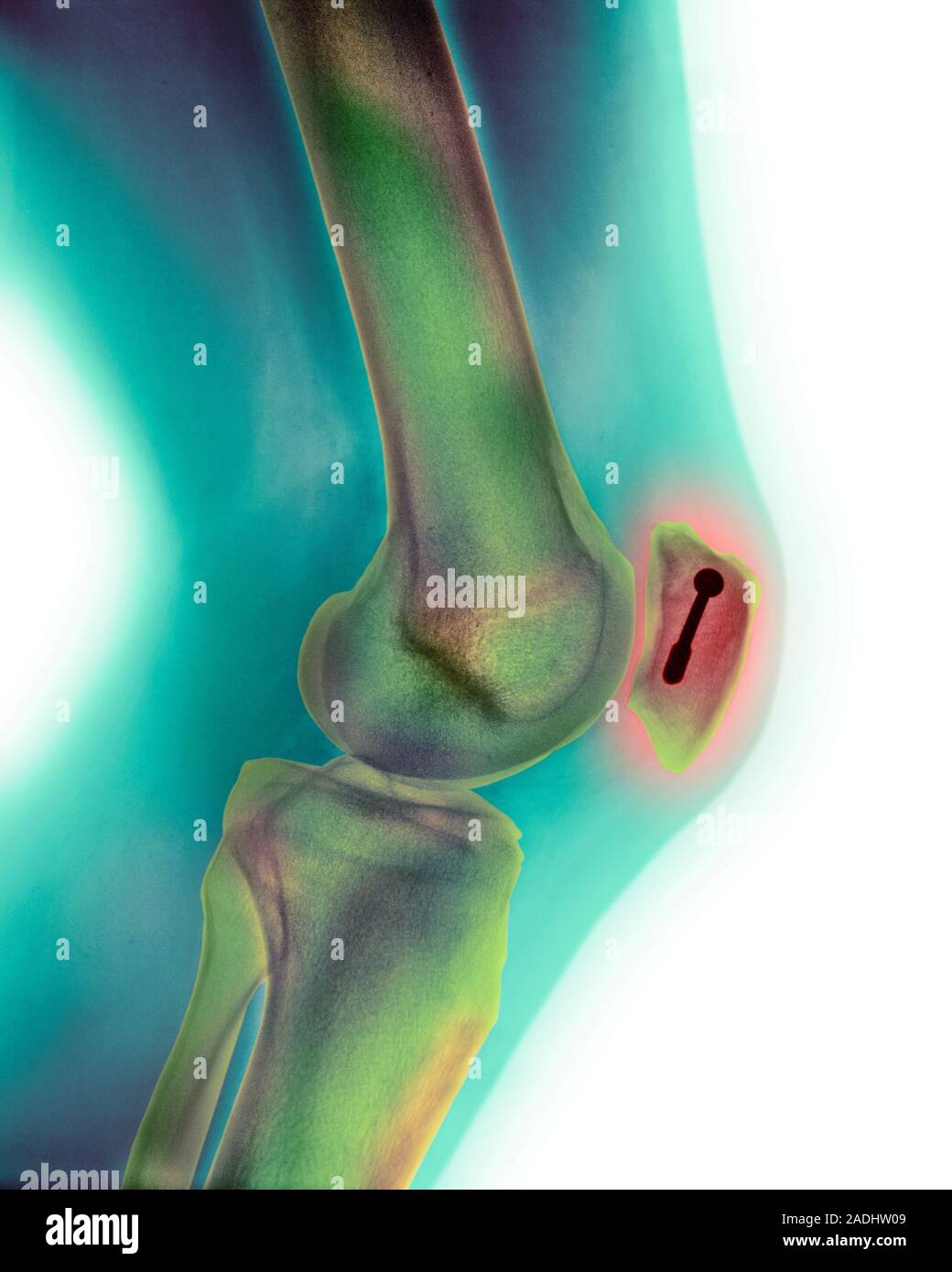 Pinned kneecap fracture. Coloured X-ray of a pin (black, centre right ...