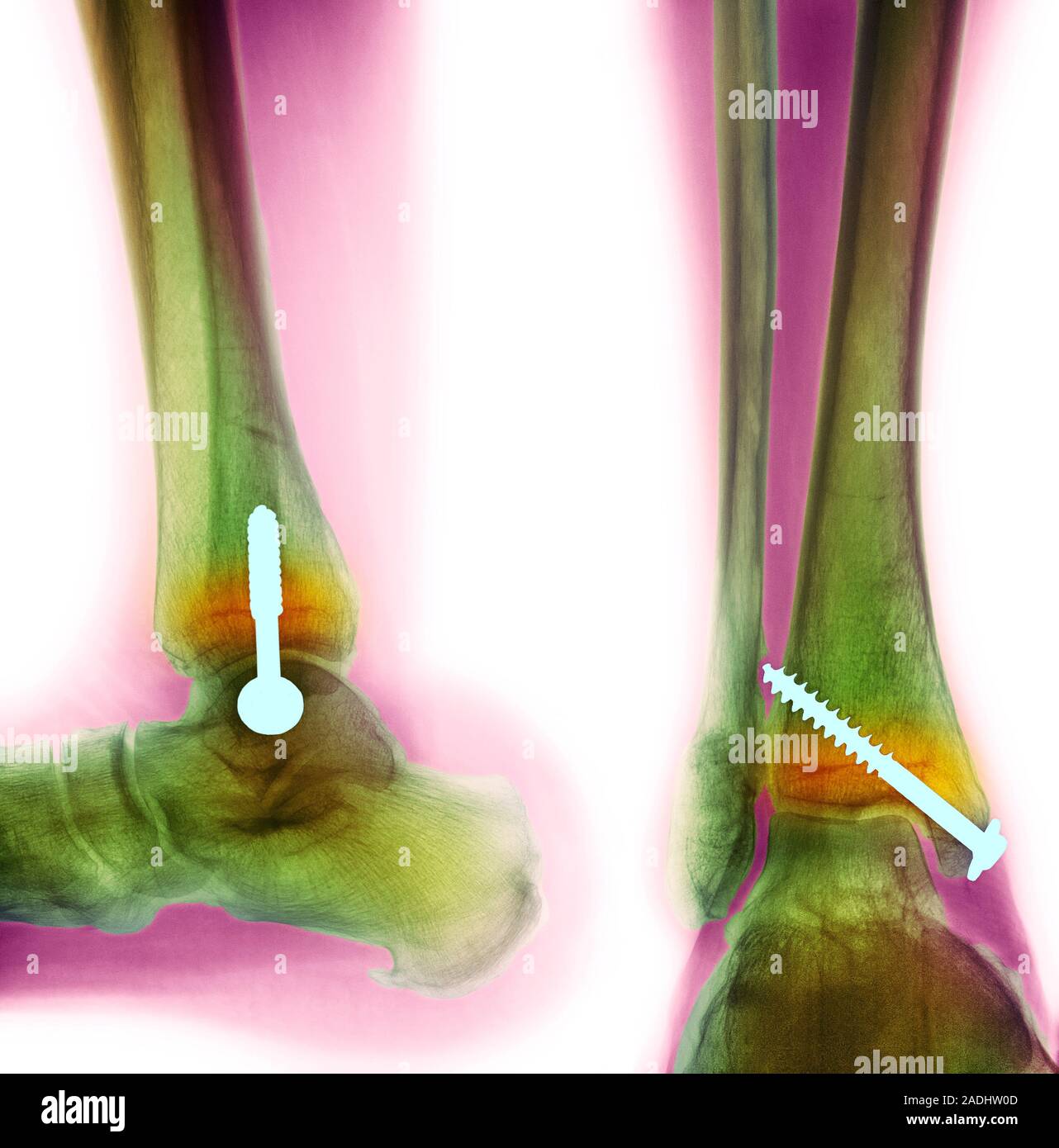 Pinned ankle fracture. Coloured X-rays showing two views of a pinned ...