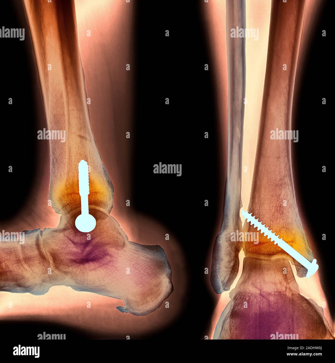 Pinned ankle fracture. Coloured X-rays showing two views of a pinned ...