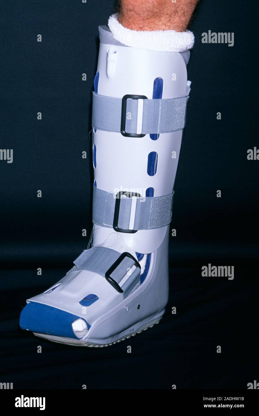 Ruptured Achilles tendon. Leg of a 47-year-old male patient wearing a ...