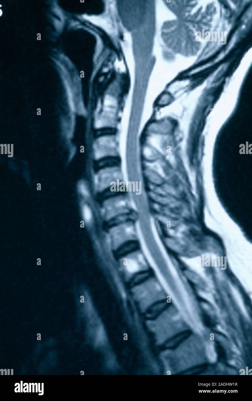 Slipped disc. Sagittal (side view) magnetic resonance imaging (MRI ...
