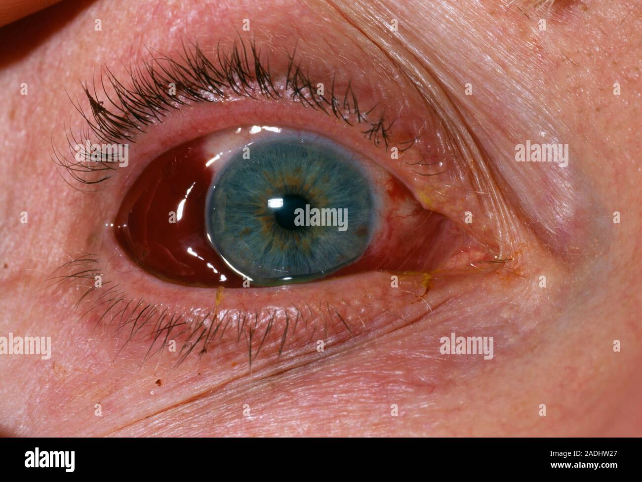 Eye injury. Blood in a 62-year-old woman's eye. This is subconjunctival ...